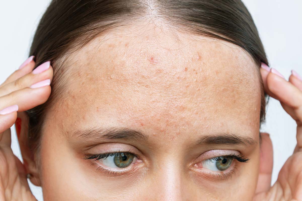 Akne behandeln in Berlin Zehlendorf.